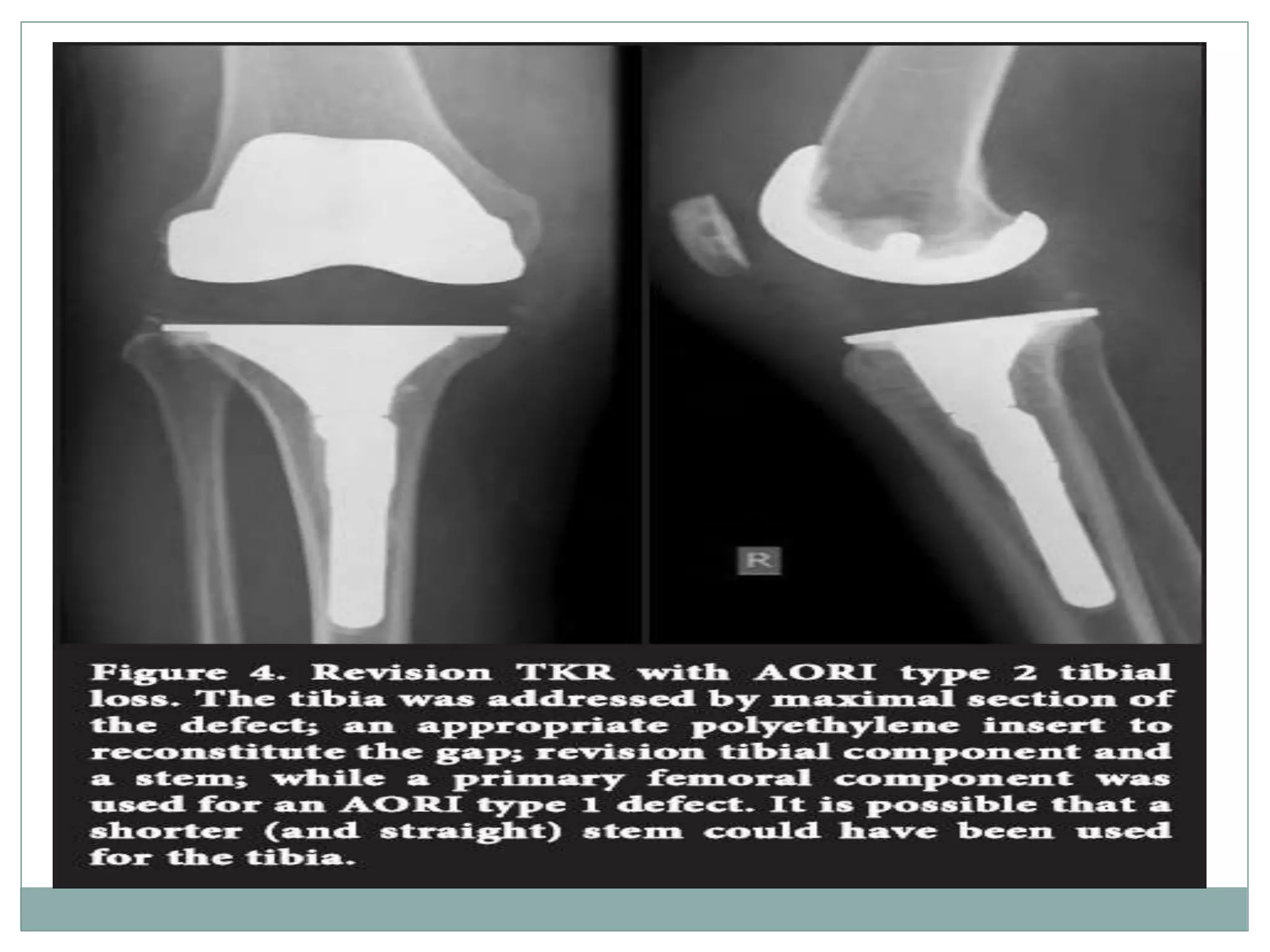 Bone defects in tkr | PPT