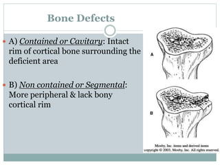 Bone defects in tkr | PPT