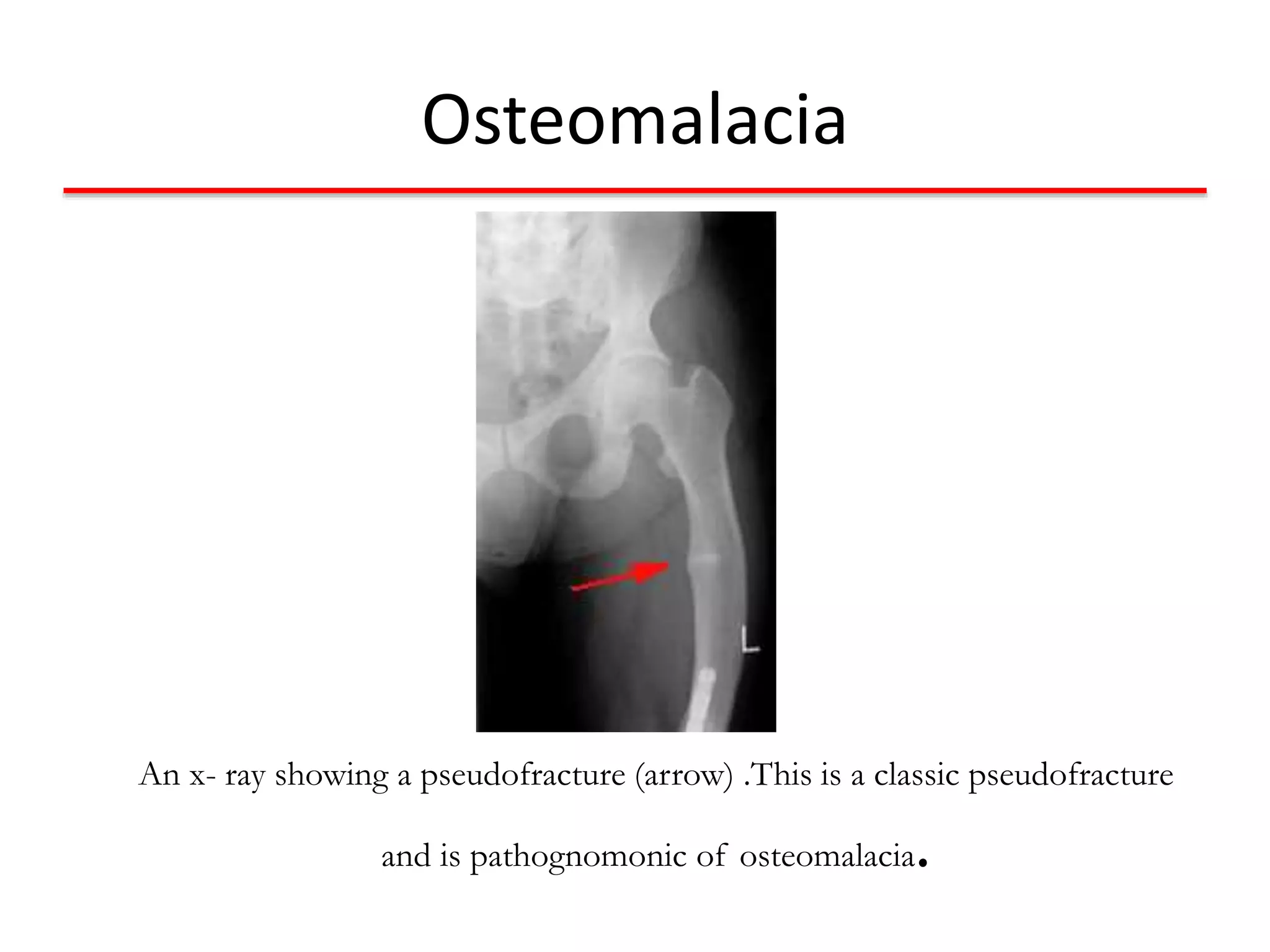 Bone demineralization | PPTX