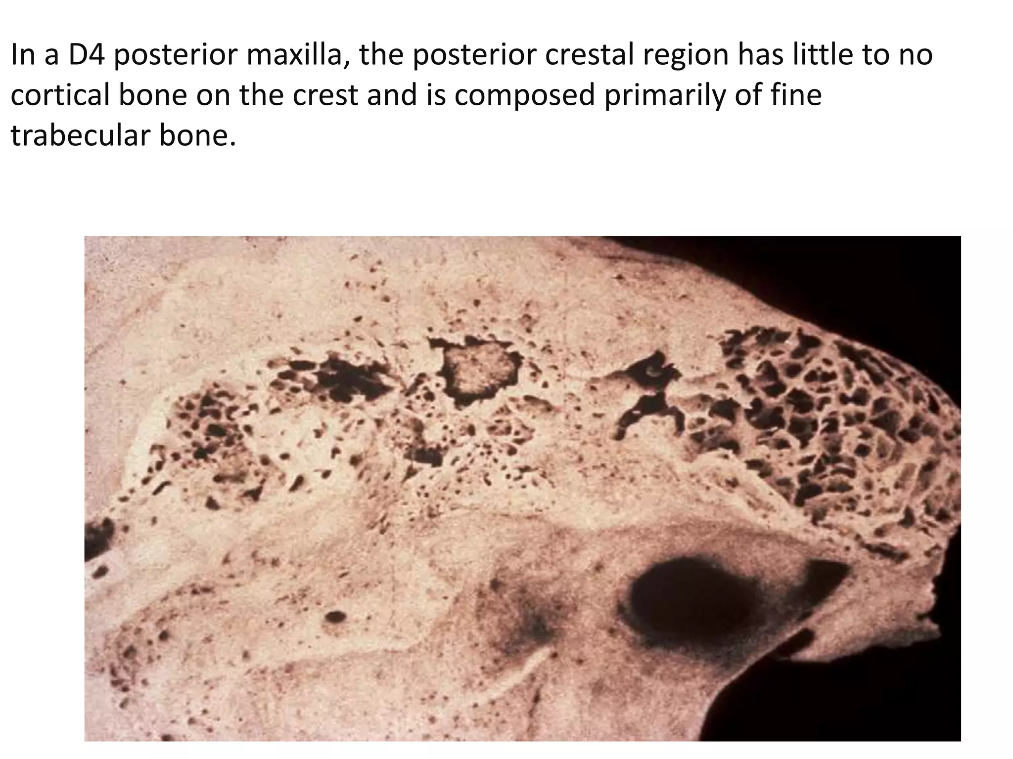 Bone density for dental implant. | PPTX