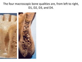 Bone density for dental implant. | PPTX