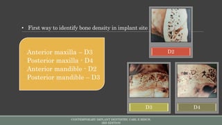 Bone density ppt | PPTX