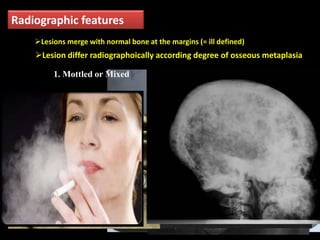 Bone diseases 2014 | PPTX