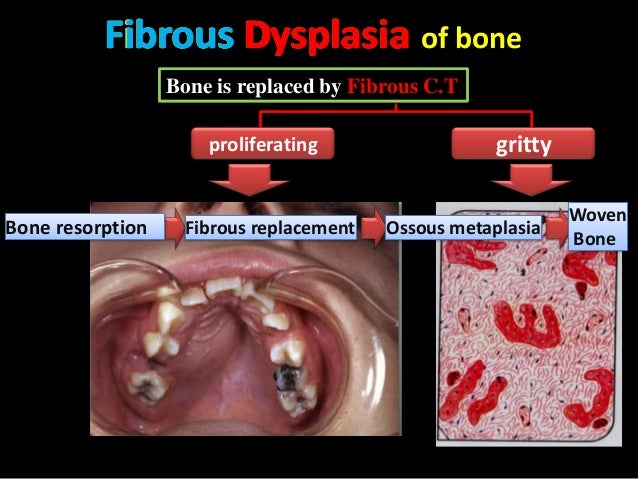 Bone diseases 2014