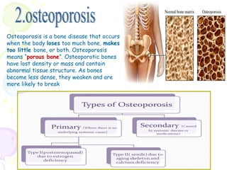 Bone disorders | PPT