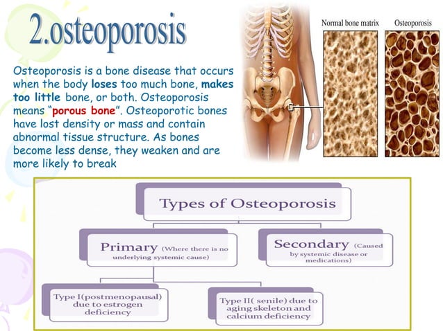 Bone disorders | PPT | Bone and Joint Conditions | Diseases and Conditions