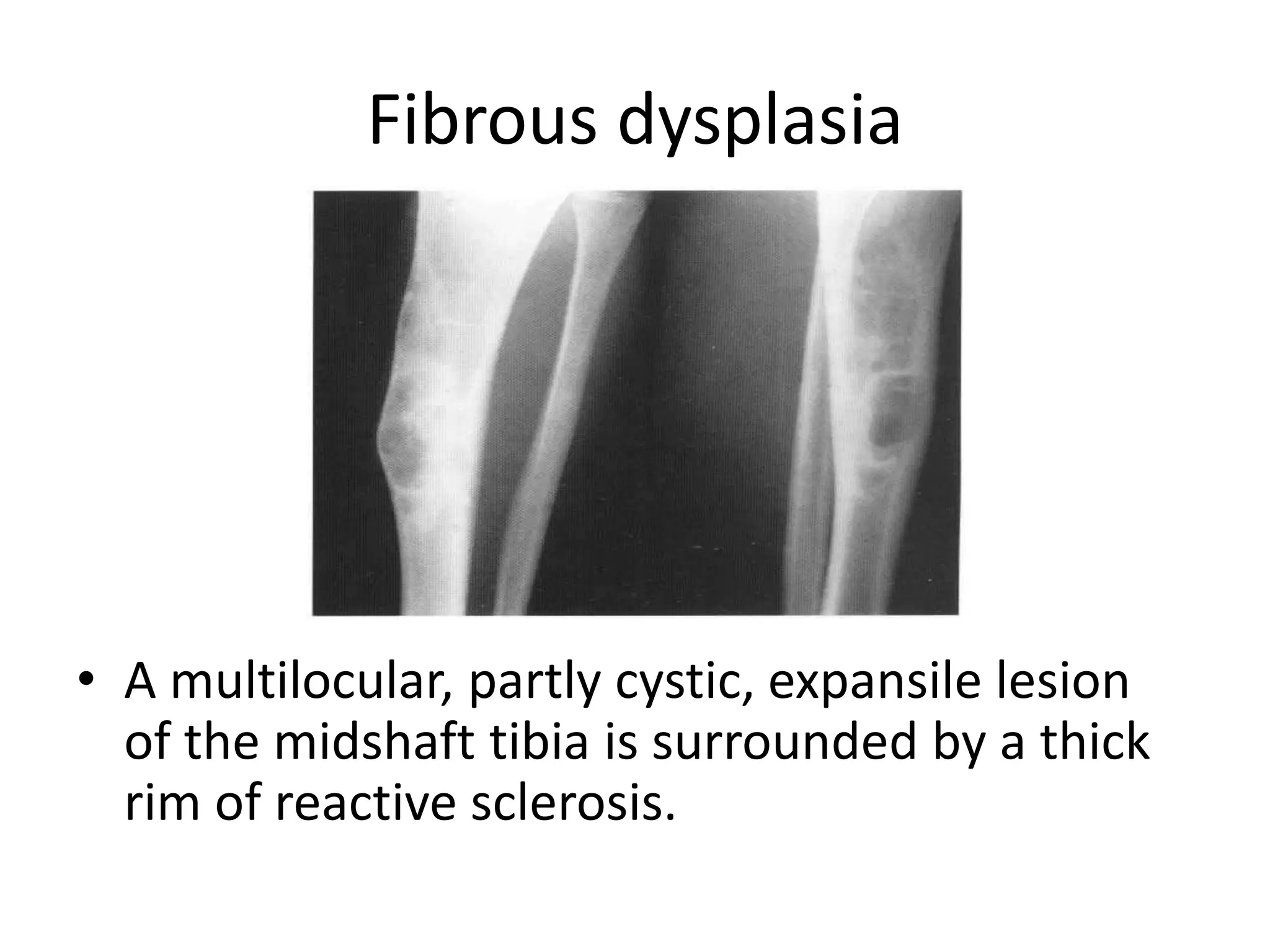 Bone dyspalsia | PPT