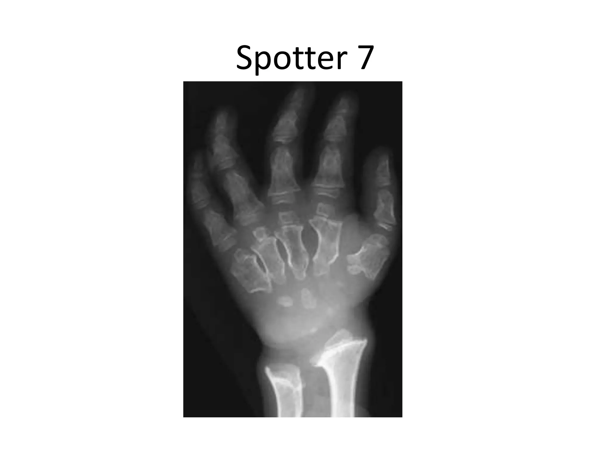 Bone dyspalsia | PPT