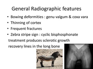 Bone dyspalsia | PPT