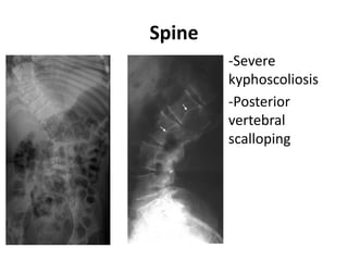 Bone dyspalsia | PPT