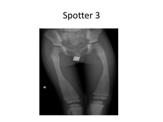 Bone dyspalsia | PPTX