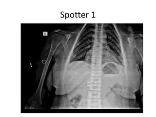 Bone dyspalsia | PPTX