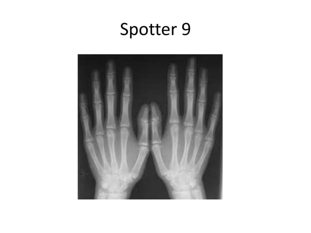 Bone dyspalsia | PPT
