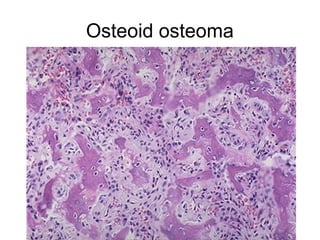 Osteoid Osteoma Histology