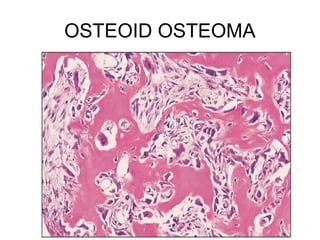 Osteoid Osteoma Histology