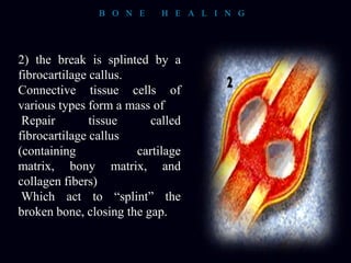 Bonefracture 091120114305-phpapp02 | PPTX