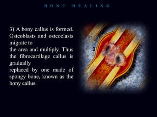 Bonefracture 091120114305-phpapp02 | PPTX