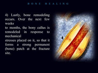 Bonefracture 091120114305-phpapp02 | PPTX