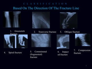 Bonefracture 091120114305-phpapp02 | PPTX