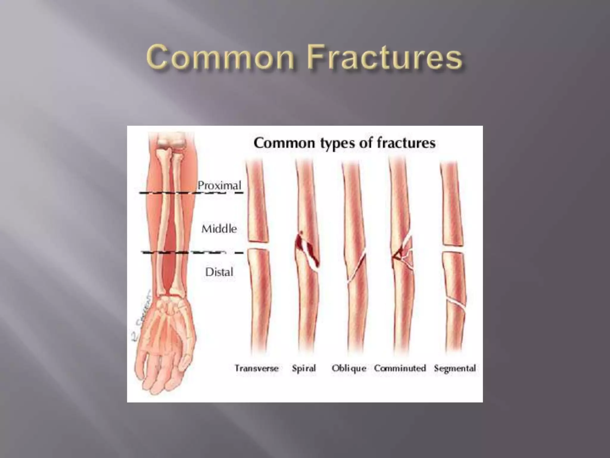 Bone fracture | PPTX