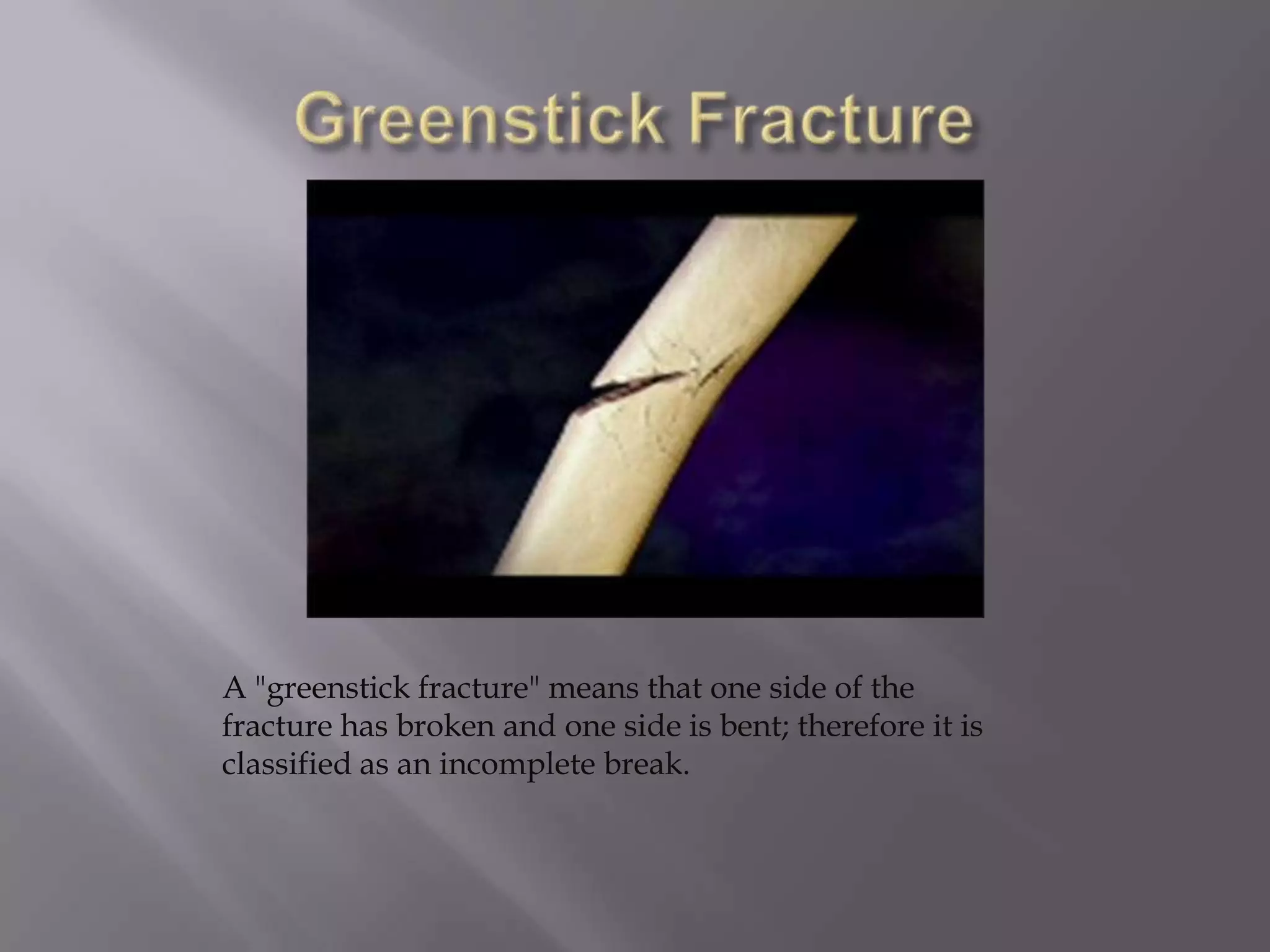 Bone fracture | PPTX