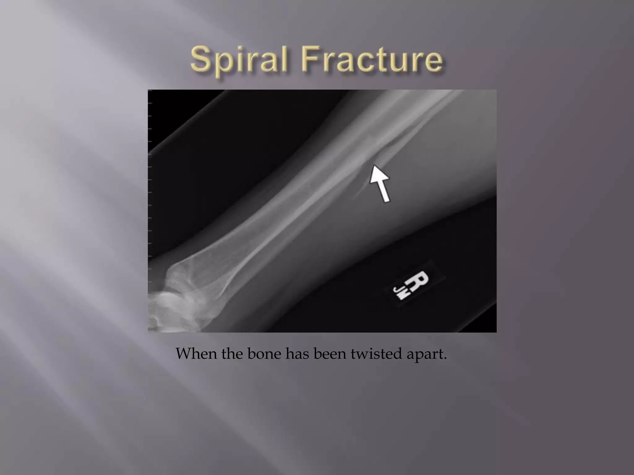 Bone fracture | PPTX