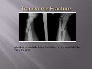 Bone fracture | PPTX