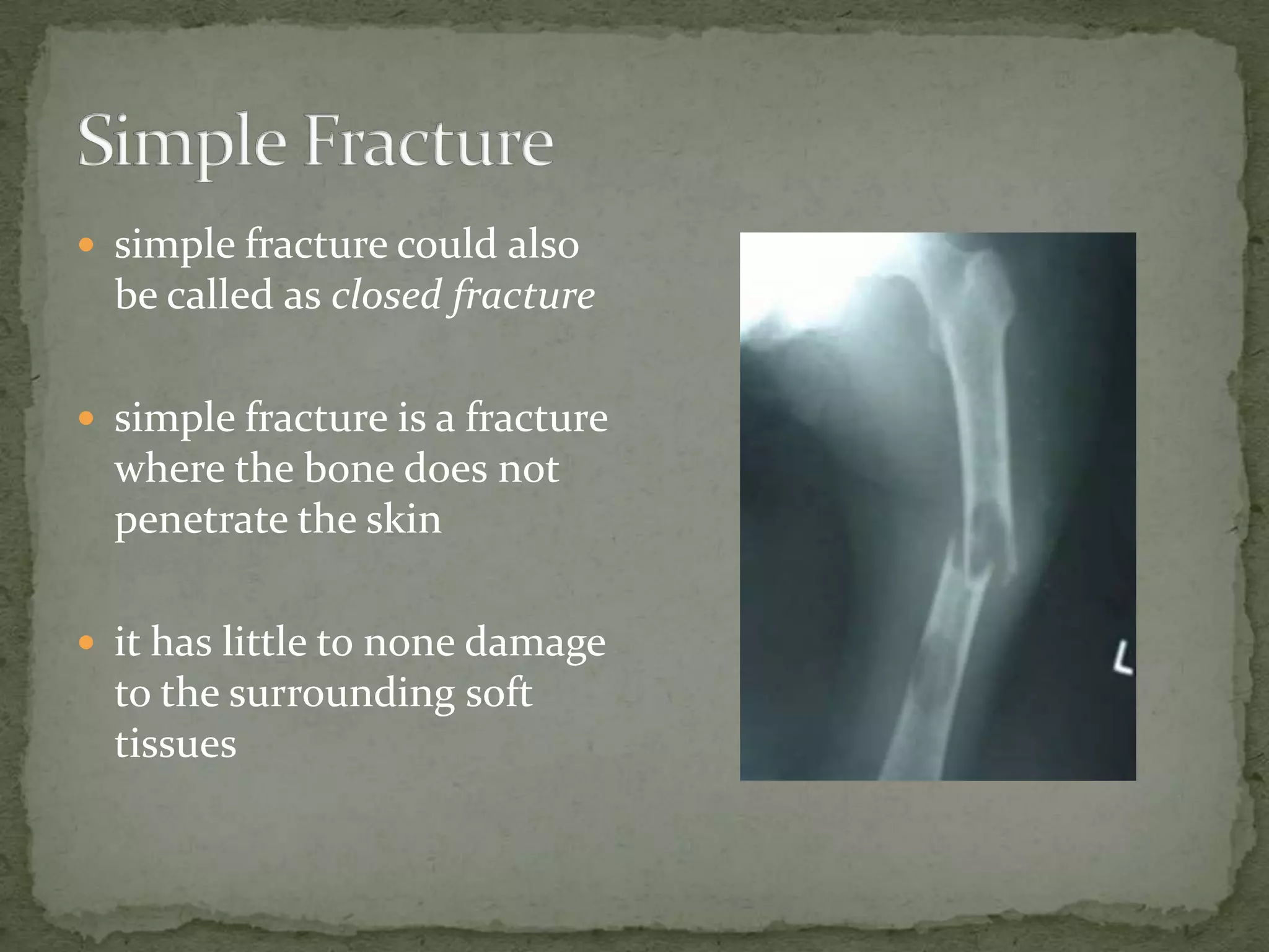 Bone fracture | PPTX