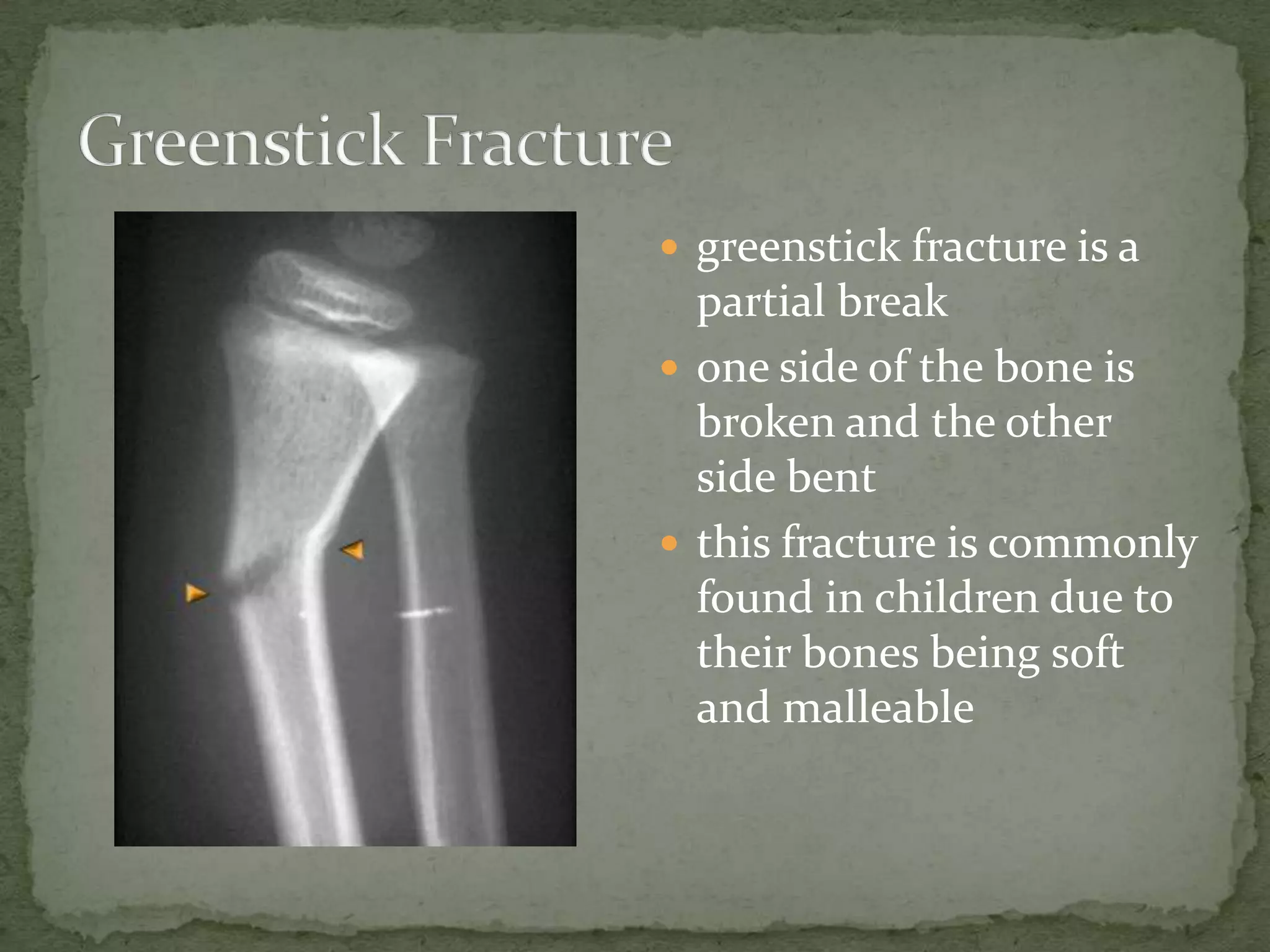 Bone fracture | PPTX