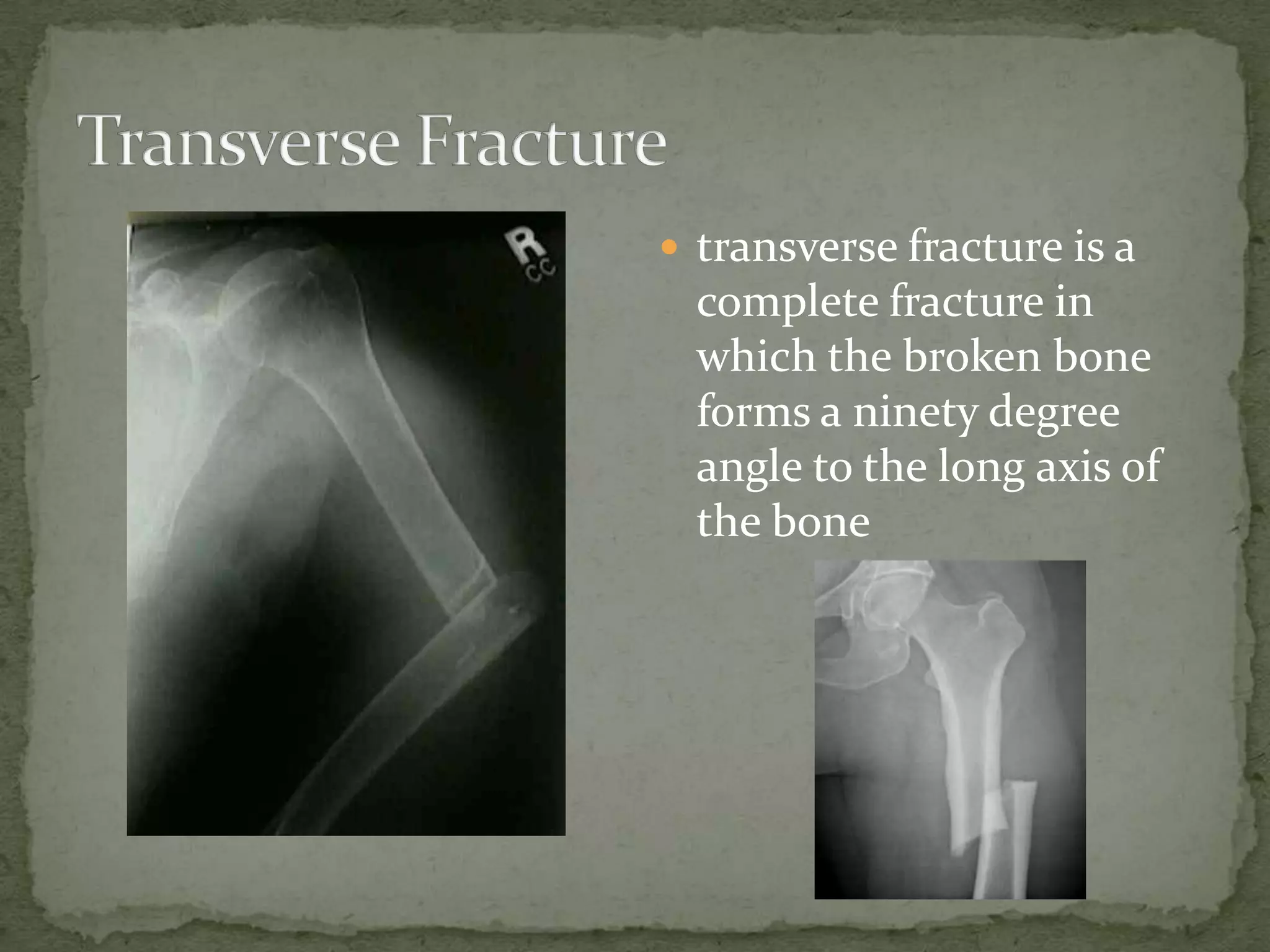 Bone fracture | PPTX