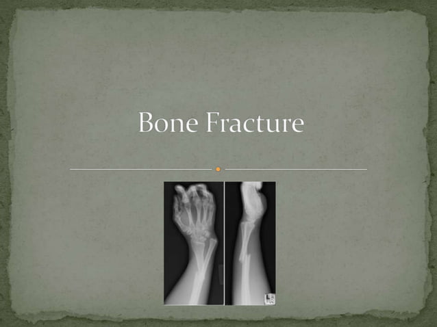 Bone fracture | PPTX