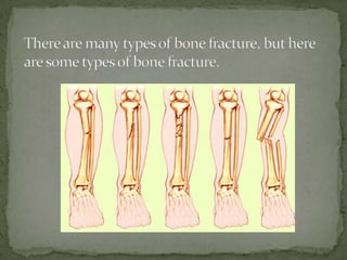 Bone fracture | PPTX