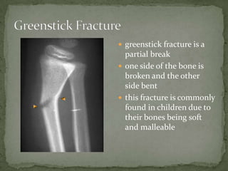 Bone fracture | PPTX