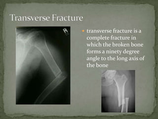 Bone fracture | PPTX
