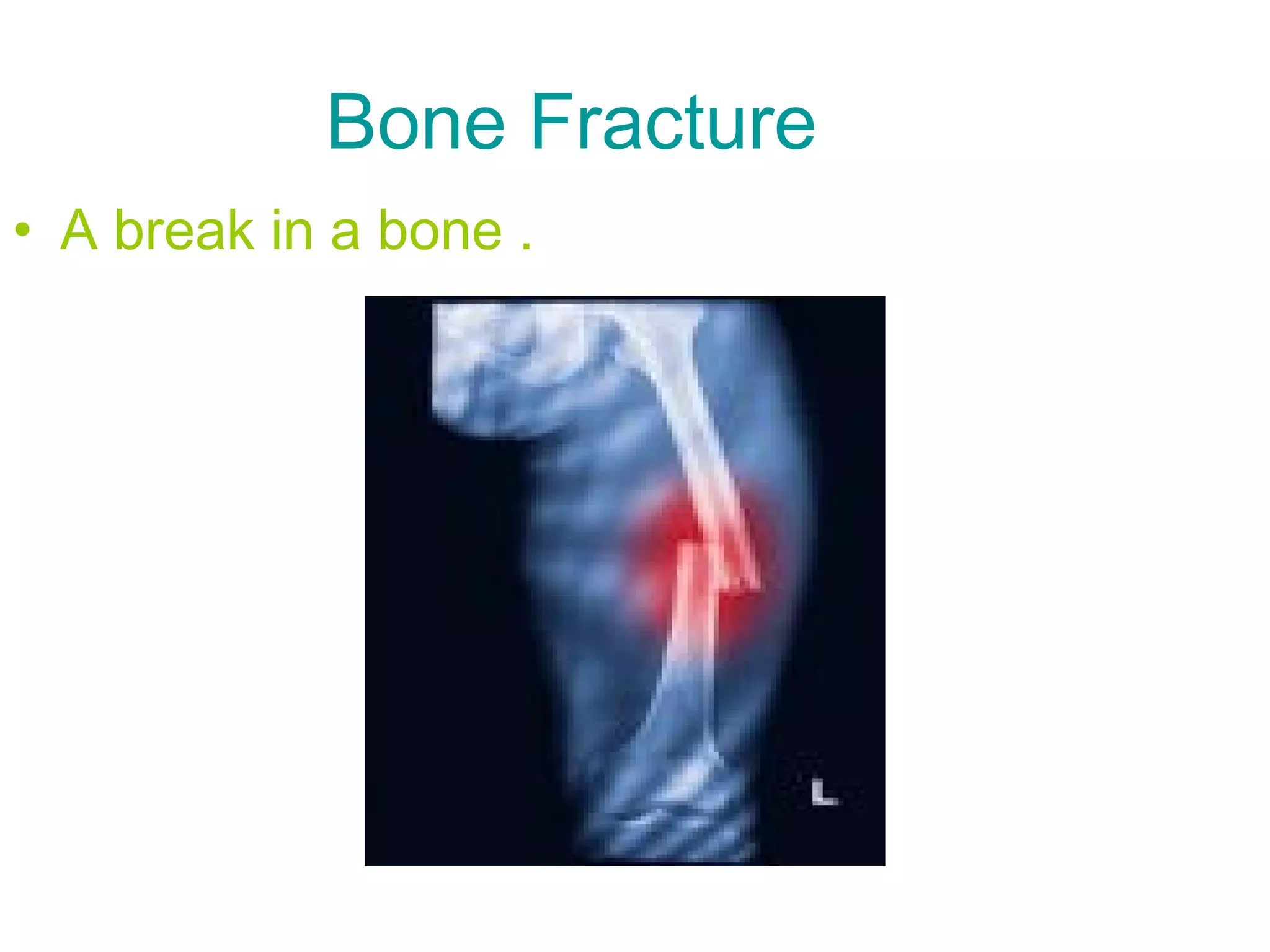 Bone fracture | PPT
