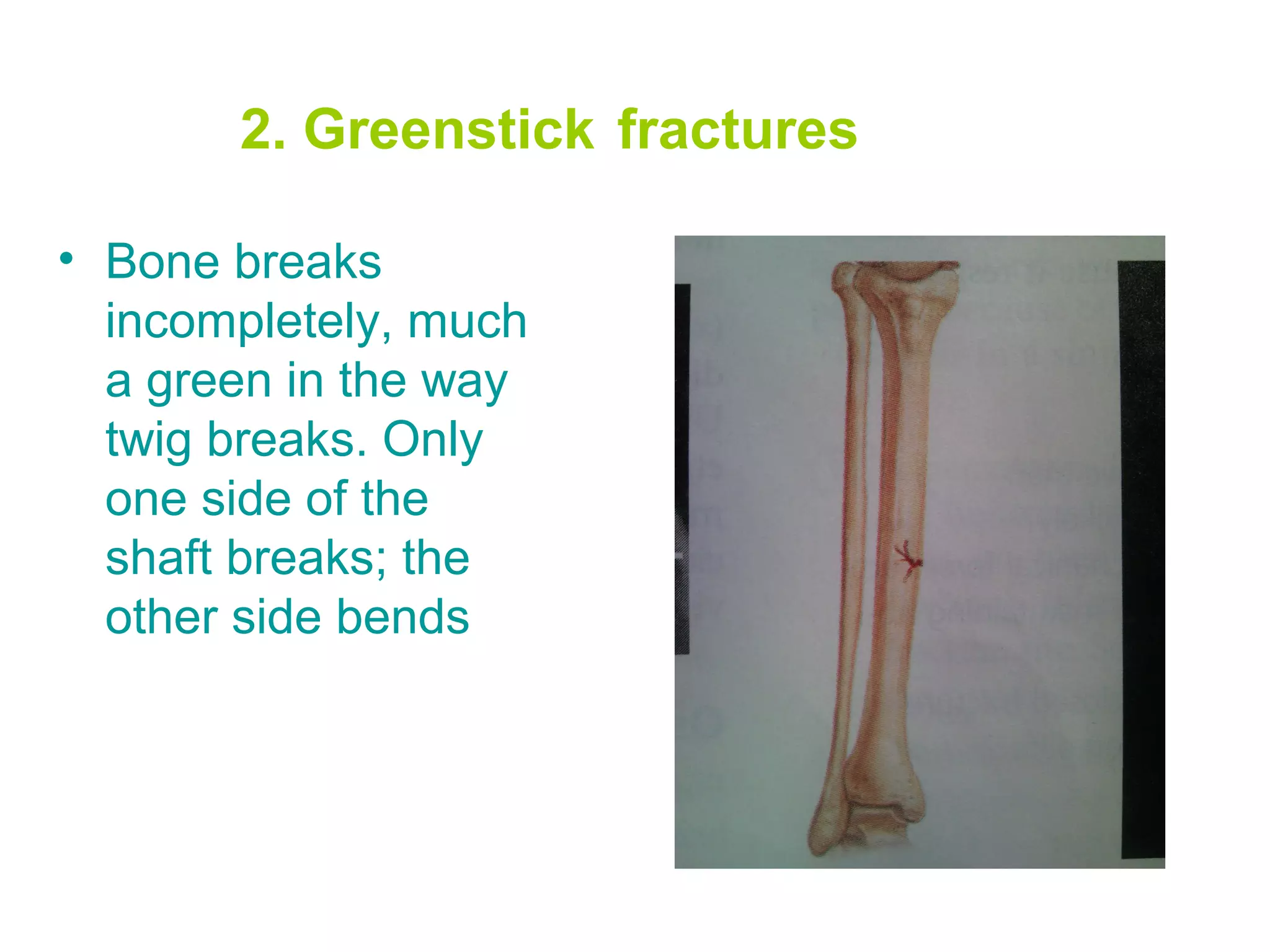 Bone fracture | PPT