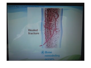 Bone fracture | PPT