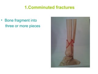 Bone fracture | PPT