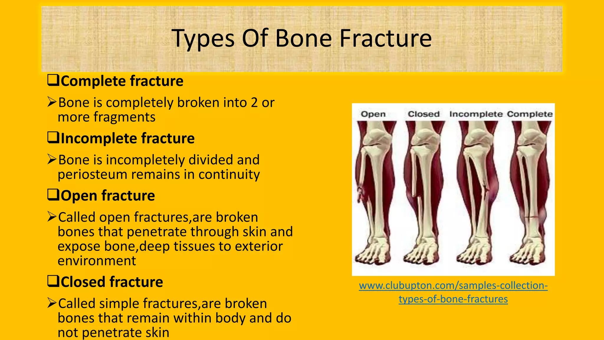 Bone fracture | PPTX