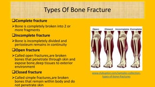 Bone fracture | PPTX