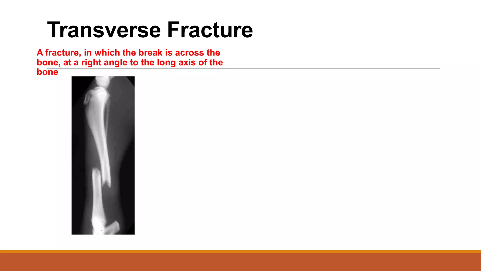BONE FRACTURE.pptx