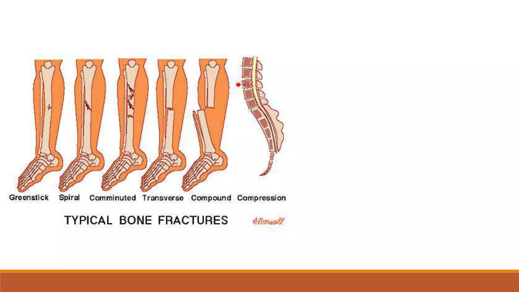 BONE FRACTURE.pptx