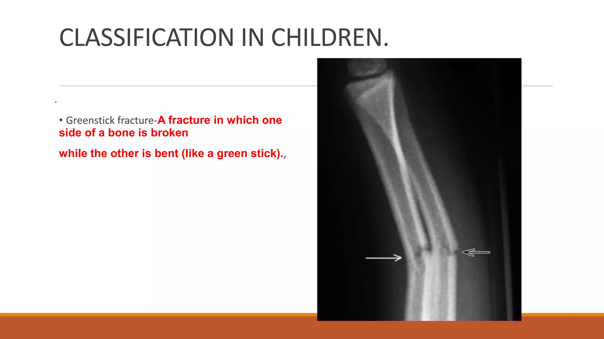BONE FRACTURE.pptx