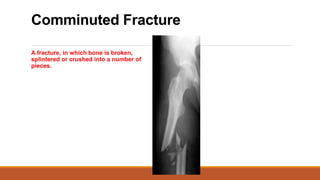 BONE FRACTURE.pptx