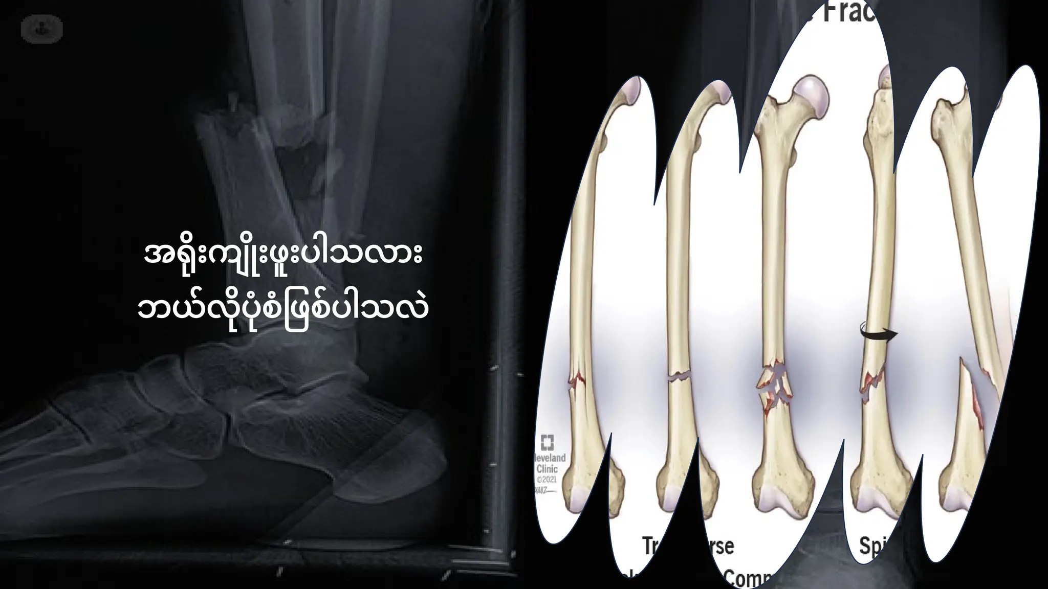 Bone fracture (basic information for ).pptx