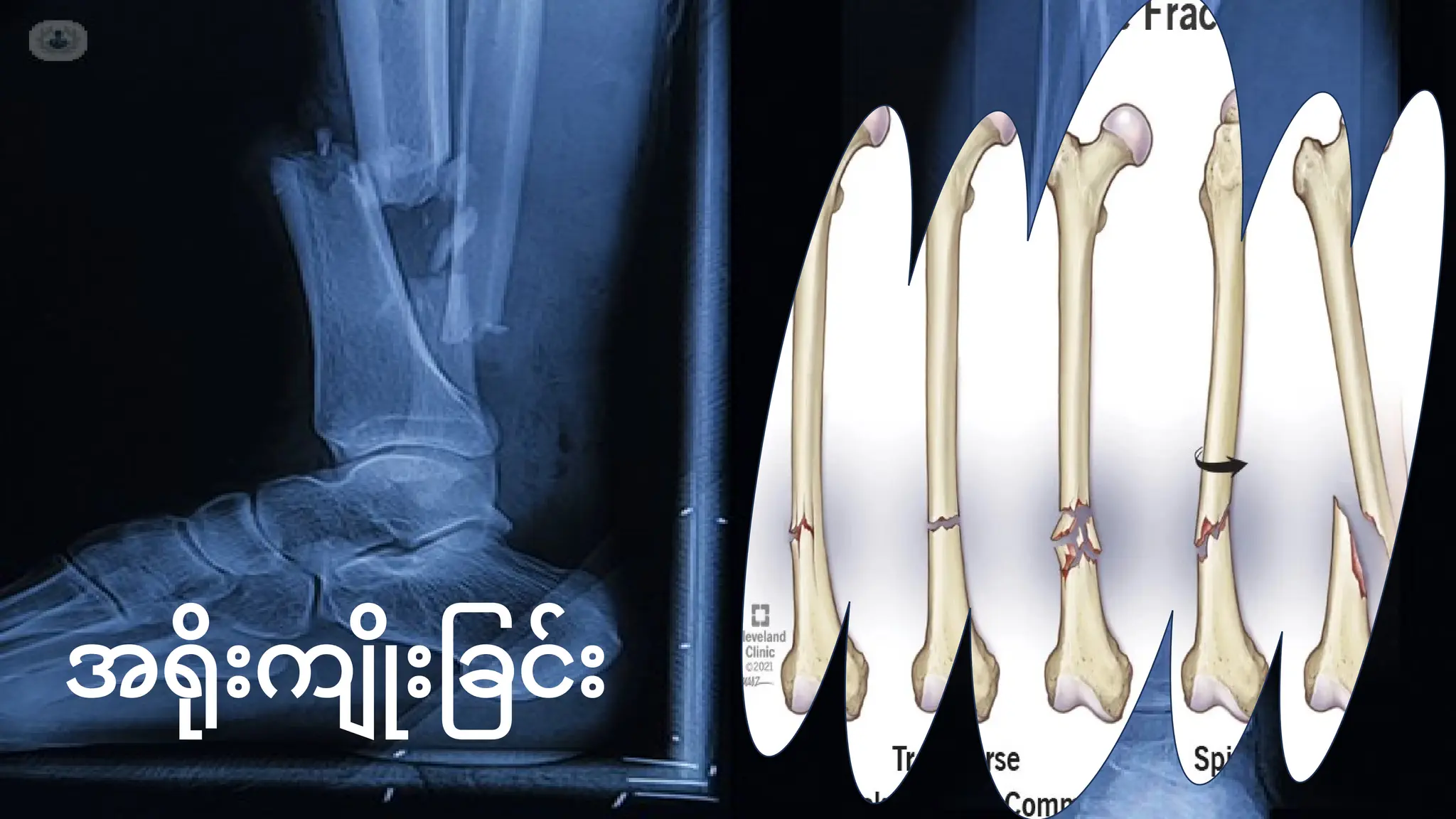 Basic information for the Bone fracture.pptx