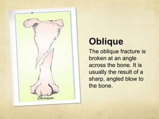Bone Fractures | PPTX