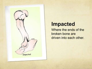 Bone Fractures | PPTX