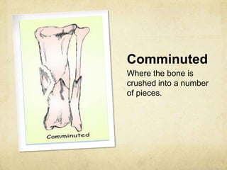 Bone Fractures | PPTX