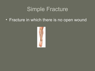 Bone Fractures | PPT